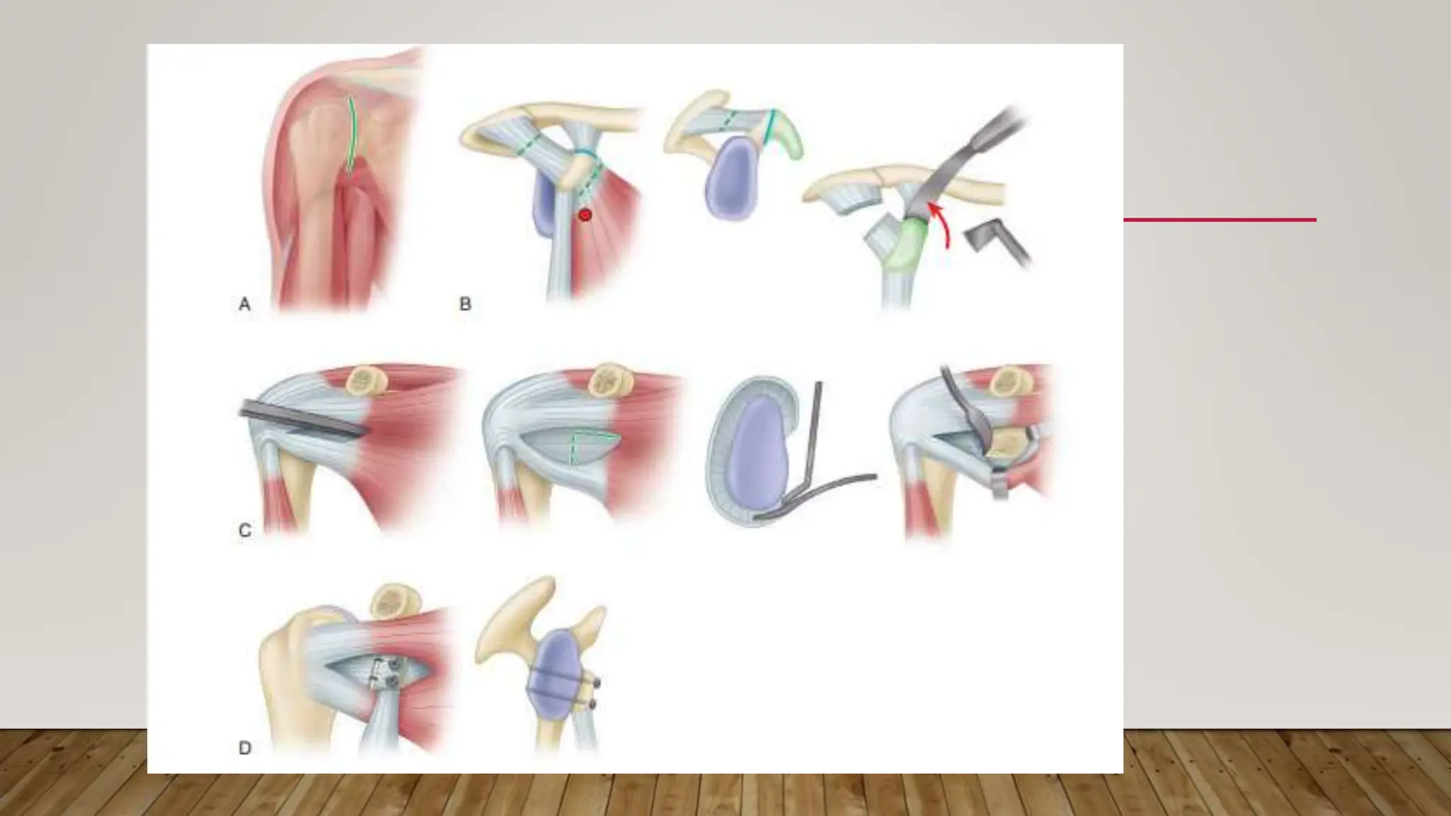 shoulder dislocation and surgical management pptx | PPTX | Death ...
