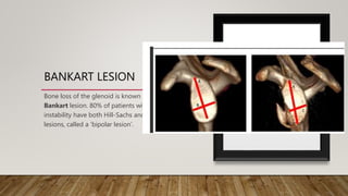 shoulder dislocation and surgical management pptx | PPTX