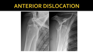 shoulder dislocation and its treatment .pptx