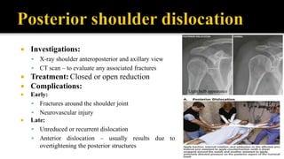 shoulder dislocation and its treatment .pptx