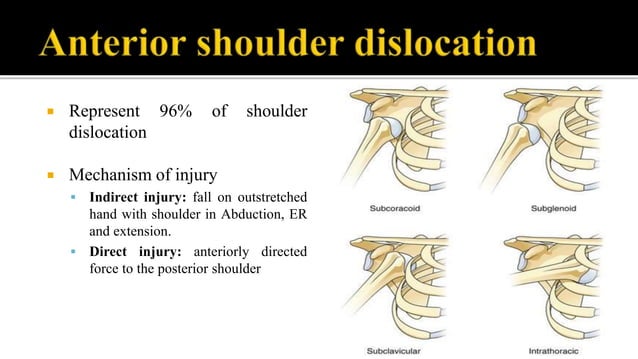 shoulder dislocation and its treatment .pptx