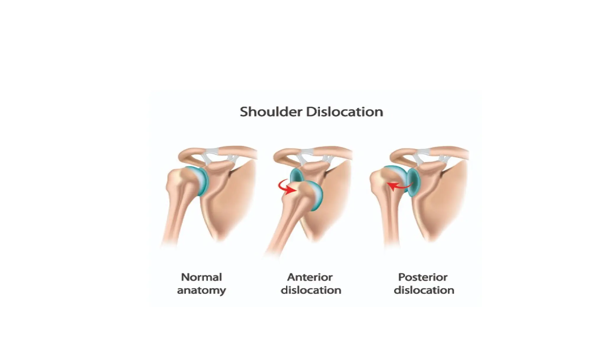 shoulder dislocation.pptx shoulder dislocation is and common scenerio in sports | PPT