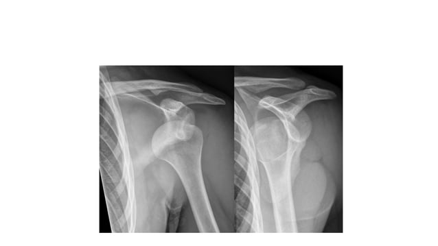 shoulder dislocation.pptx shoulder dislocation is and common scenerio ...
