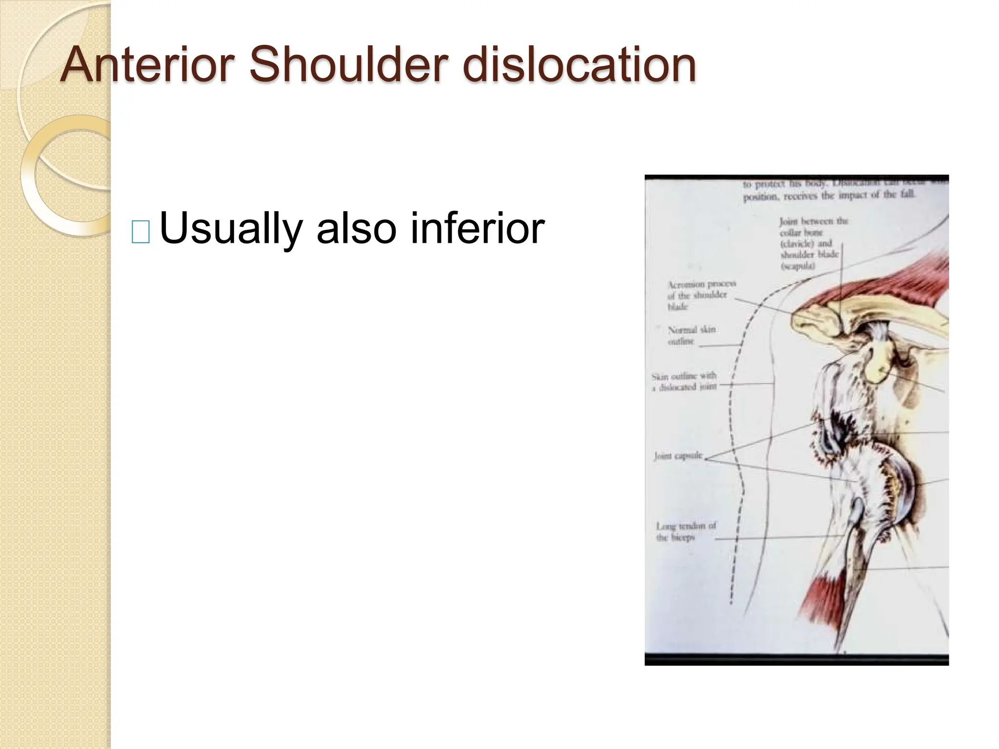 Shoulder Dislocation.pptx subject traumatology | PPTX