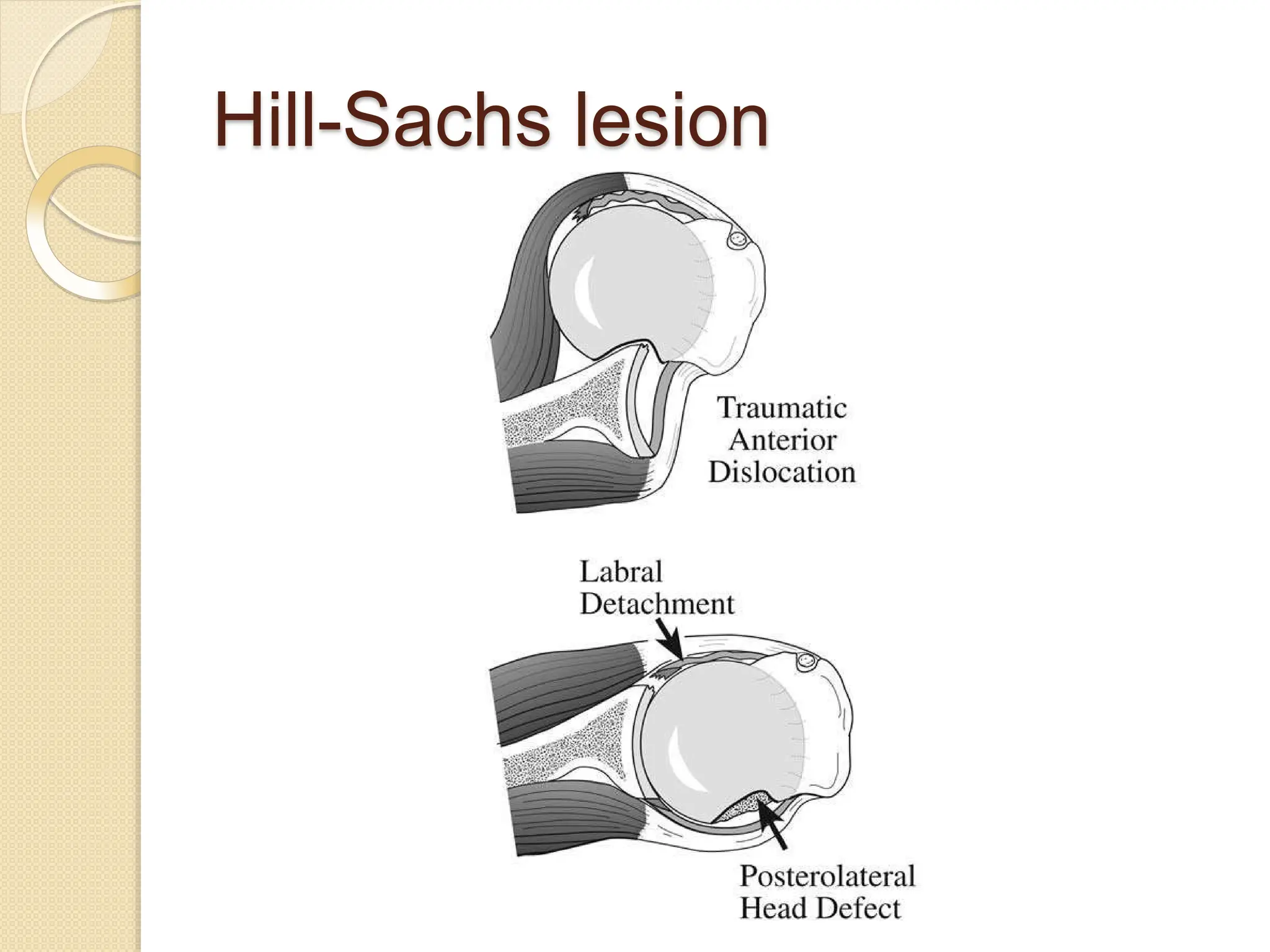 Shoulder Dislocation.pptx subject traumatology | PPTX