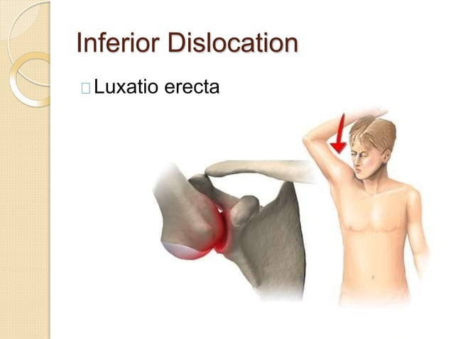 Shoulder Dislocation.pptx subject traumatology | PPT