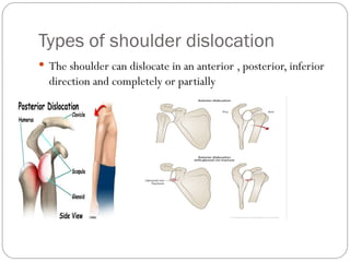 SHOULDER DISLOCATION.pptx twende tu , Mungu njo dawa | PPT