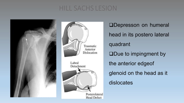 Shoulder dislocation: Types and Management Methods of Reduction | PPTX