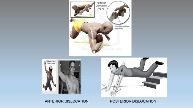 Shoulder dislocation: Types and Management Methods of Reduction | PPTX