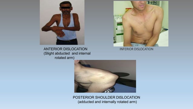 Shoulder dislocation: Types and Management Methods of Reduction | PPTX