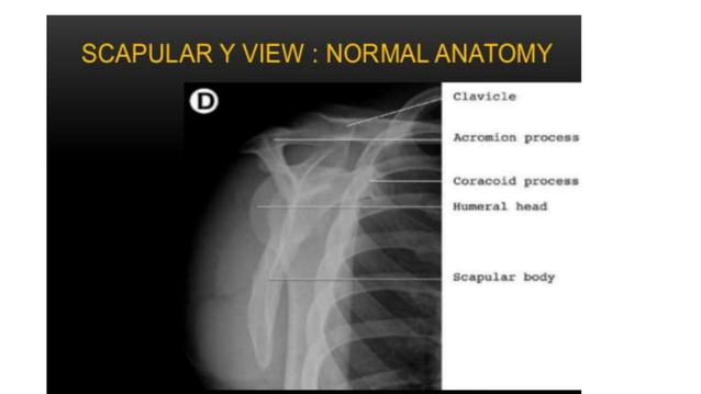 Shoulder dislocation: Types and Management Methods of Reduction | PPTX