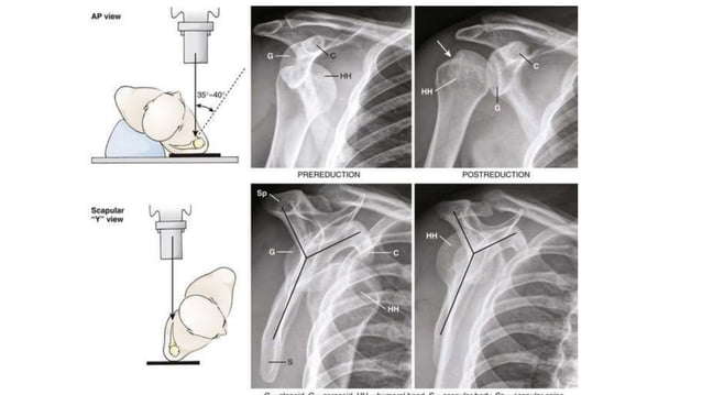Shoulder dislocation: Types and Management Methods of Reduction | PPTX