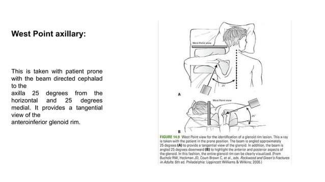 Shoulder dislocation: Types and Management Methods of Reduction | PPTX