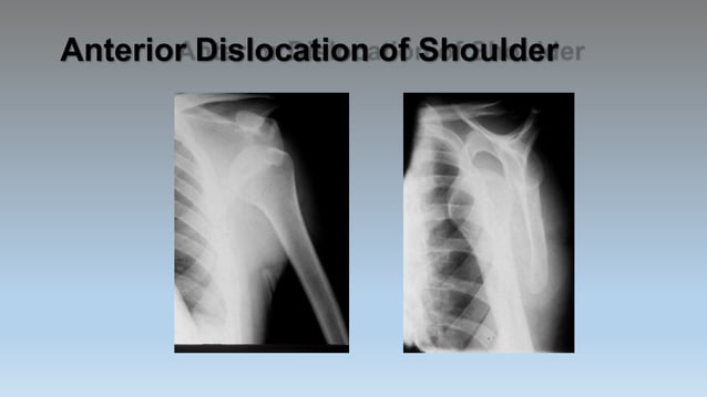 Shoulder dislocation: Types and Management Methods of Reduction | PPTX