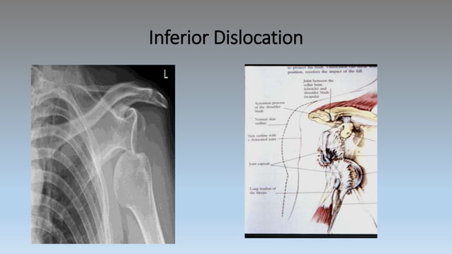 Shoulder dislocation: Types and Management Methods of Reduction | PPTX