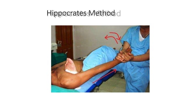 Shoulder dislocation: Types and Management Methods of Reduction | PPTX