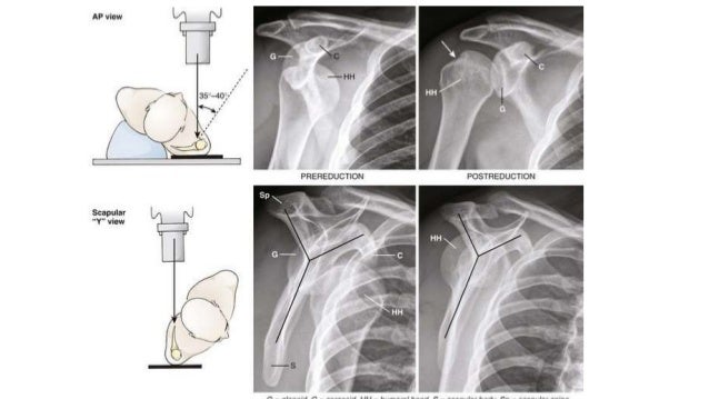 Shoulder dislocation: Types and Management Methods of Reduction
