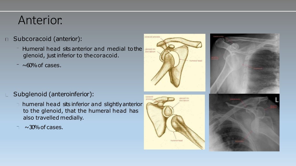 Shoulder dislocation: Types and Management Methods of Reduction