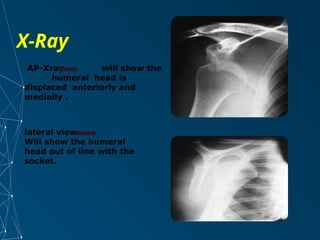 shoulder dislocation orthopaedic alqadih.pptx