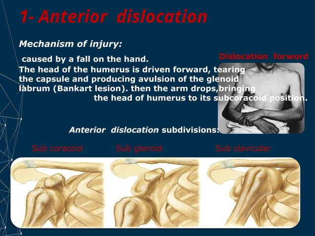 shoulder dislocation by Mohammed alqadi_١٠٤٢١٩.pptx