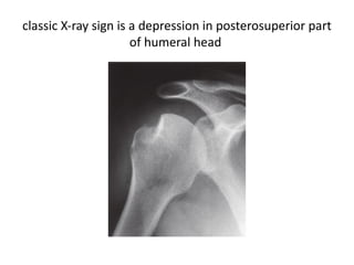 SHOULDER DISLOCATION Presentation.pptx