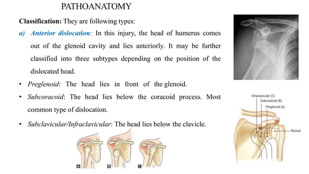 Shoulder dislocations - orthopedics.pptx