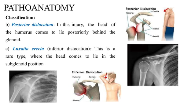 Shoulder dislocations - orthopedics.pptx
