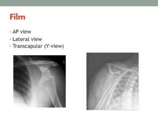 Shoulderdislo kan | PPT