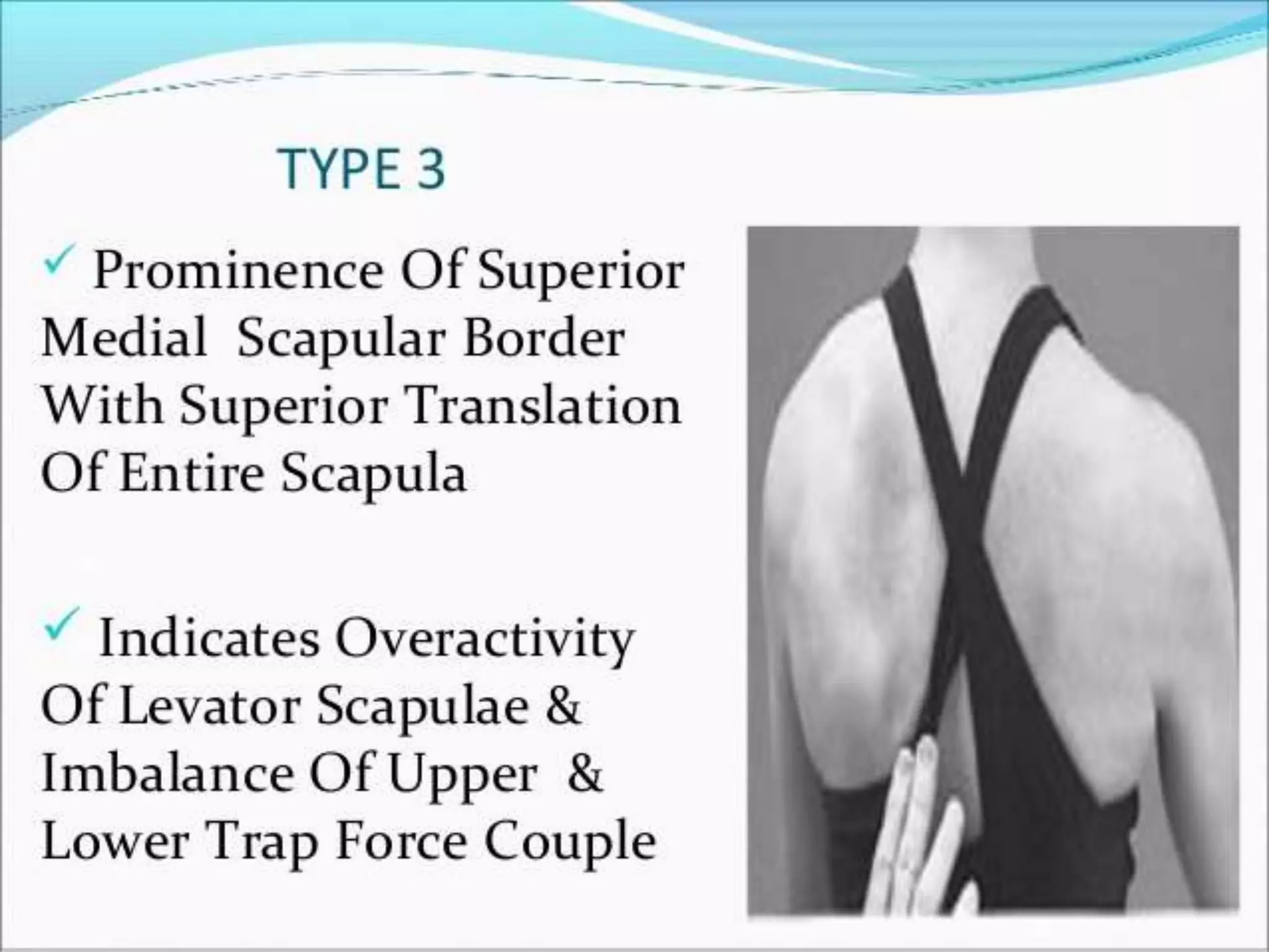shoulder dislocationcation | PPT
