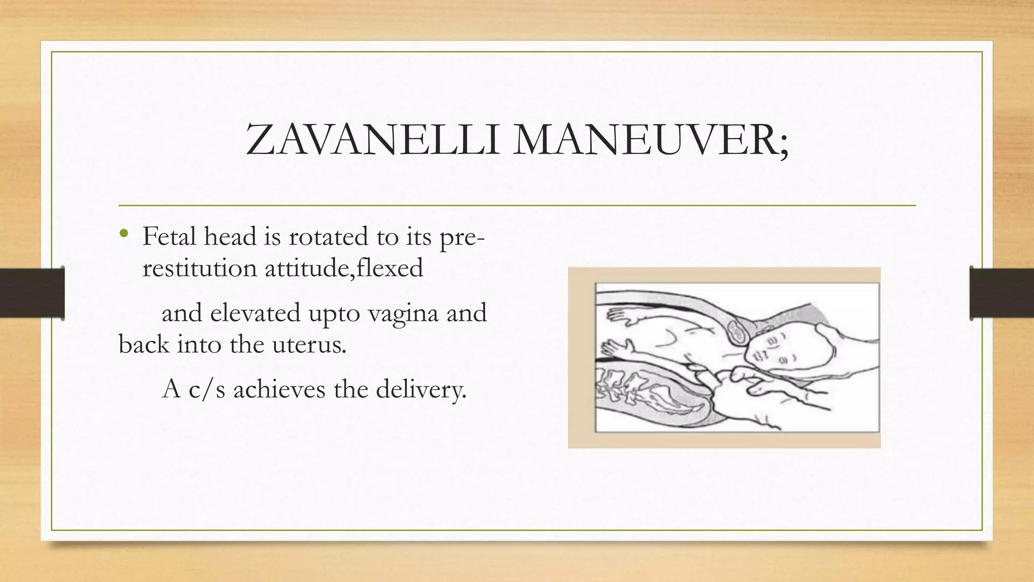 Shoulder dystocia by dr salma khwaga jaan | PPTX