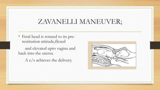 Shoulder dystocia by dr salma khwaga jaan | PPTX