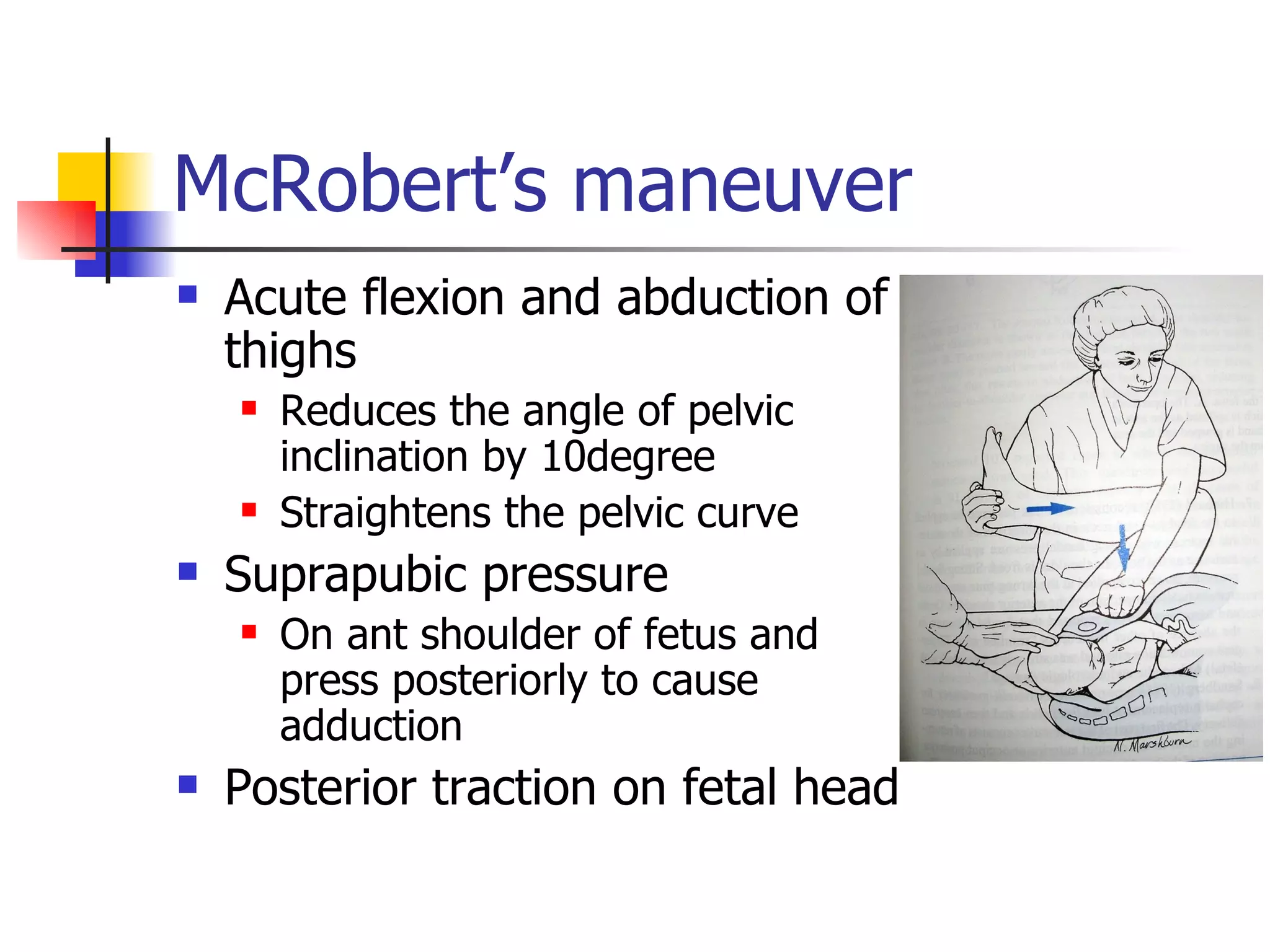 Shoulder Dystocia | PPT