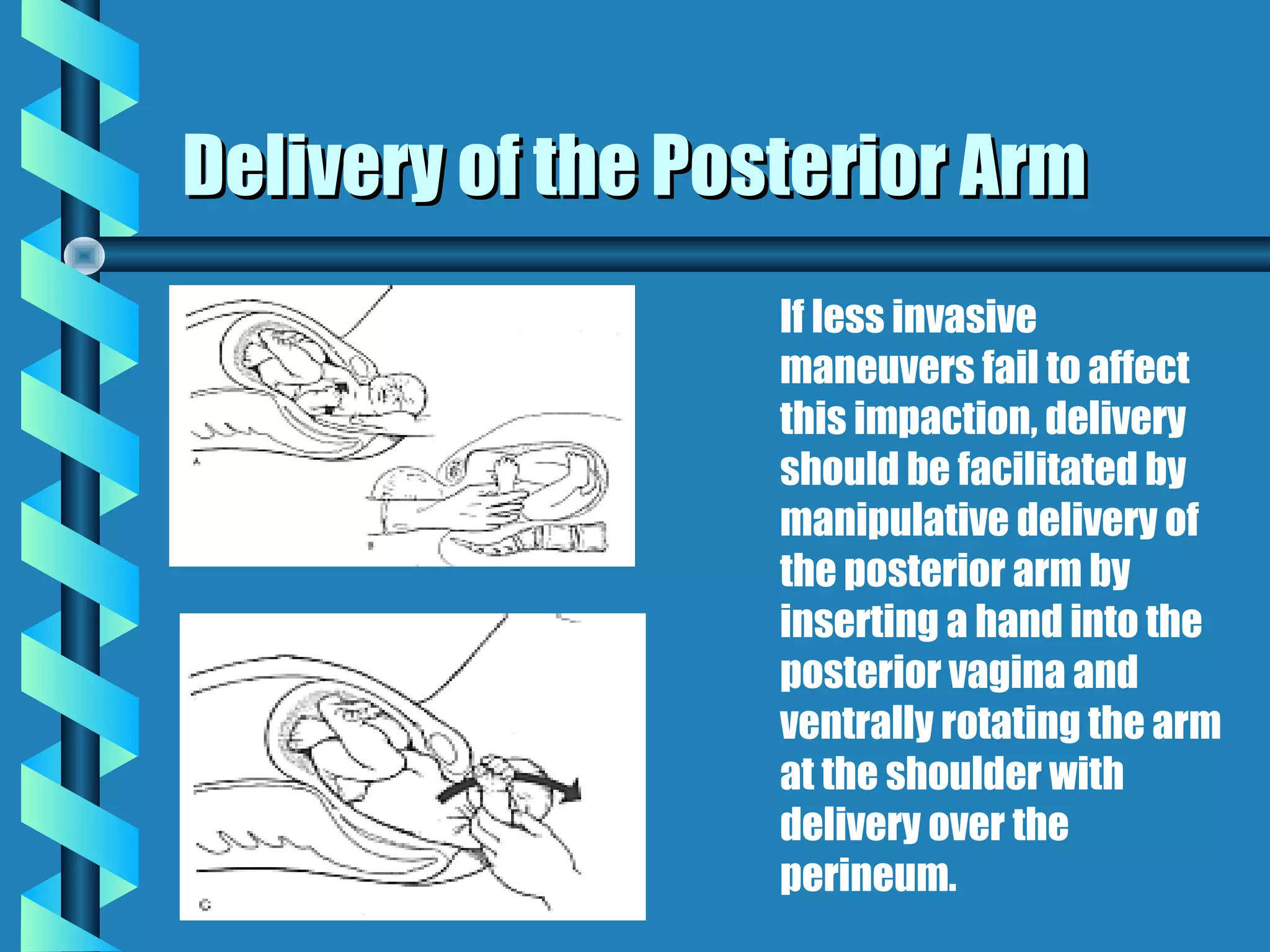 Shoulder dystocia | PPT