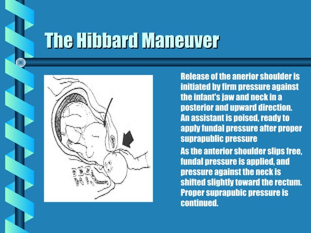 Shoulder dystocia | PPT
