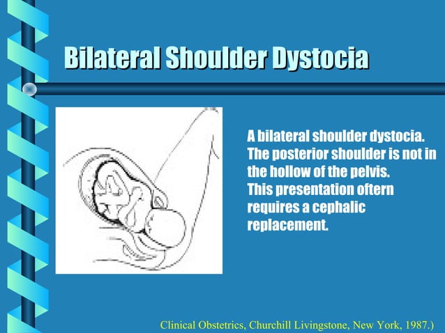 Shoulder dystocia | PPT