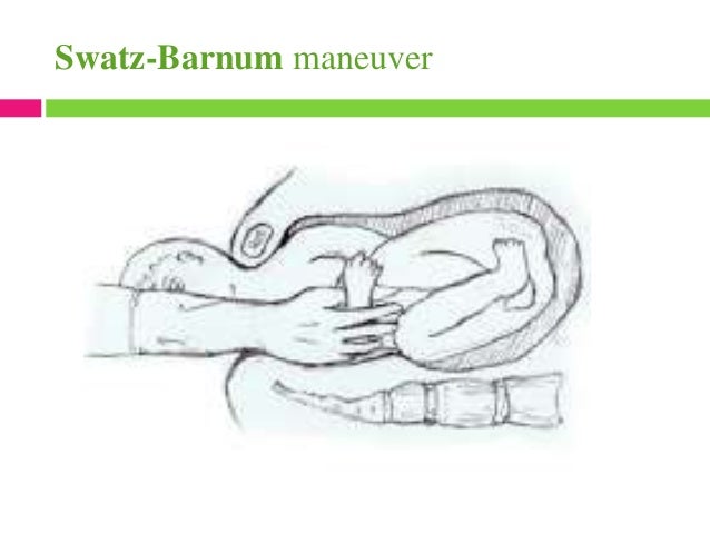 Shoulder dystocia / distocija fetlnih ramena