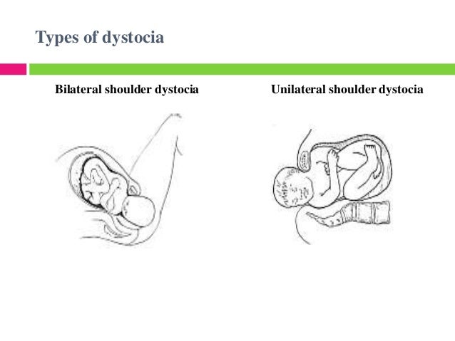 Shoulder dystocia / distocija fetlnih ramena