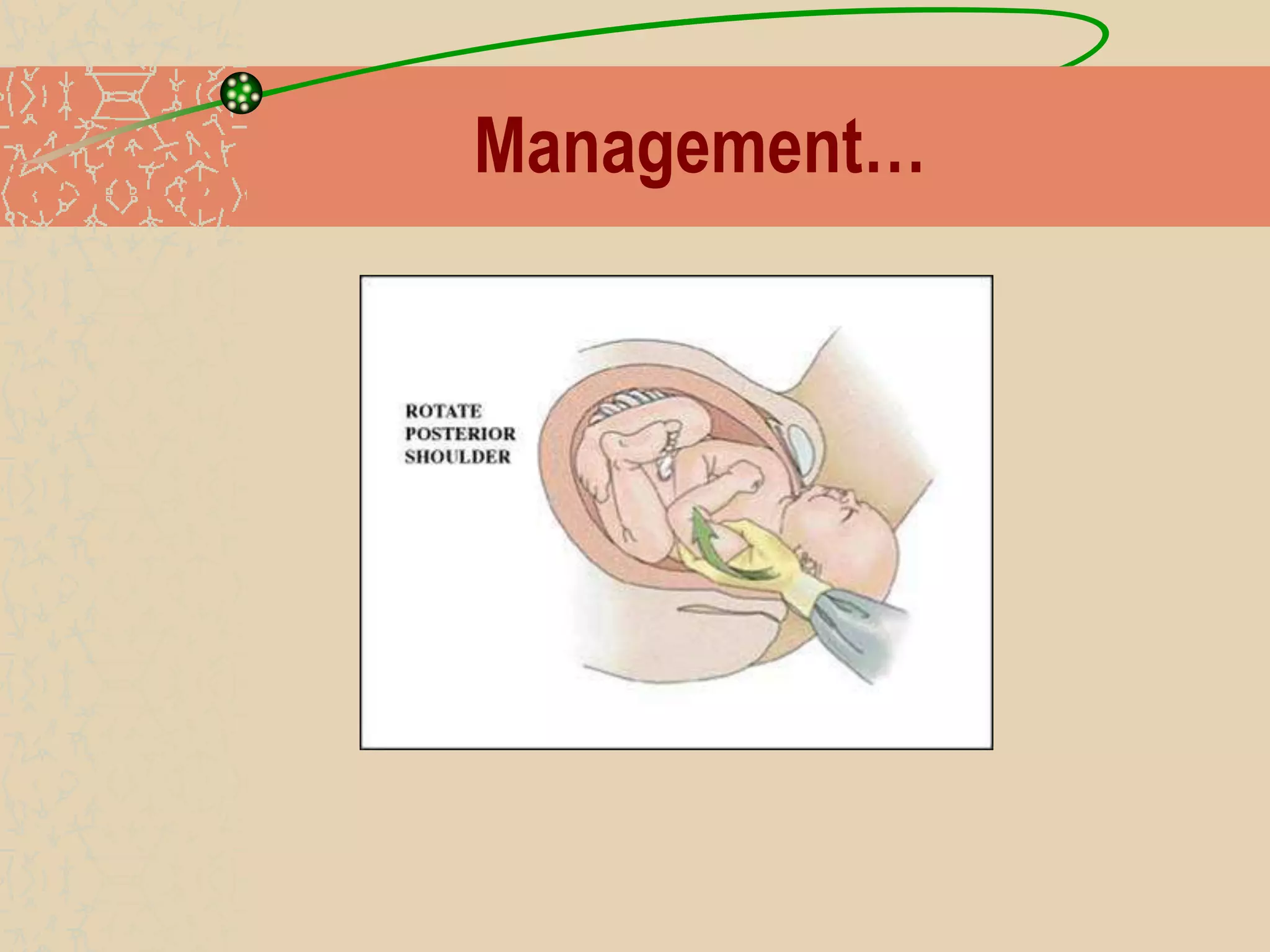 Shoulder dystocia | PPTX