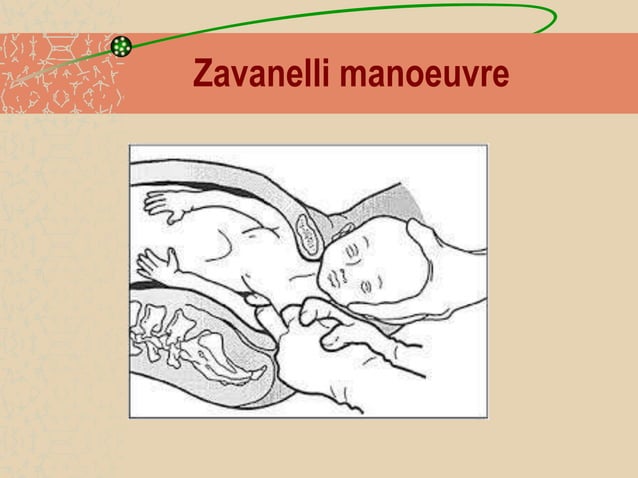 Shoulder dystocia