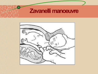 Shoulder dystocia 4th year nursing 2024. | PPTX