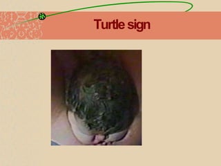 Shoulder dystocia 4th year nursing 2024. | PPT