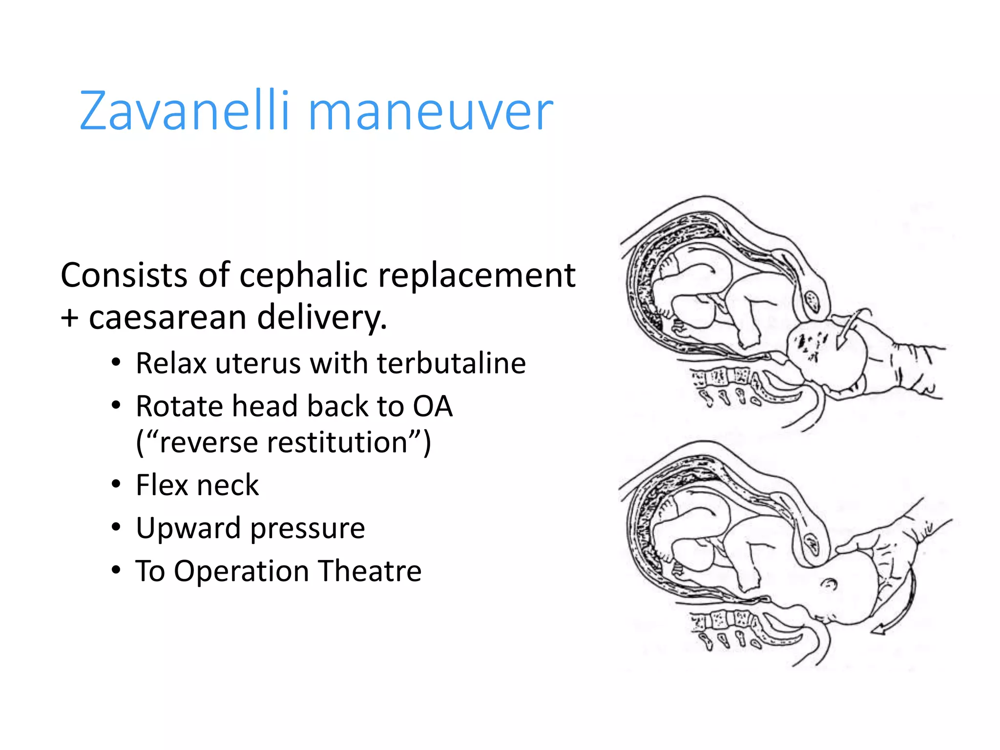 Shoulder Dystocia | PPTX
