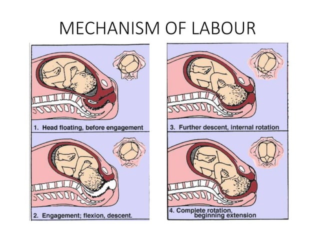 Shoulder Dystocia | PPTX | Pregnancy | Reproductive Health