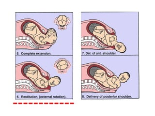 Shoulder Dystocia | PPTX | Pregnancy | Reproductive Health