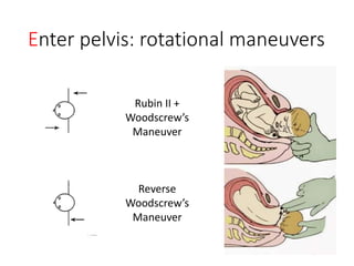 Shoulder Dystocia Maneuvers