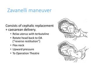 Shoulder Dystocia Maneuvers