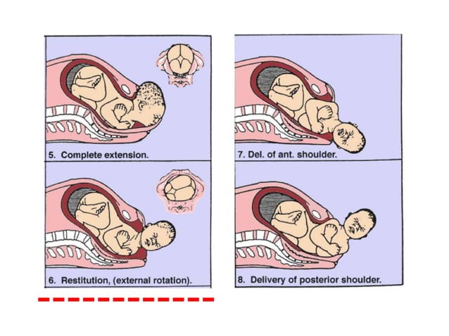 Shoulder Dystocia