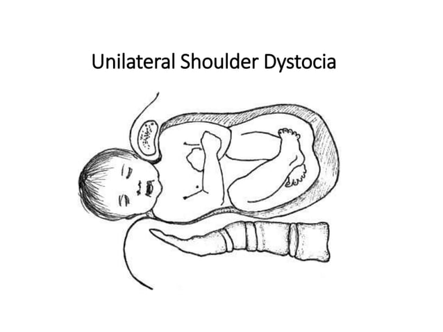 Shoulder Dystocia