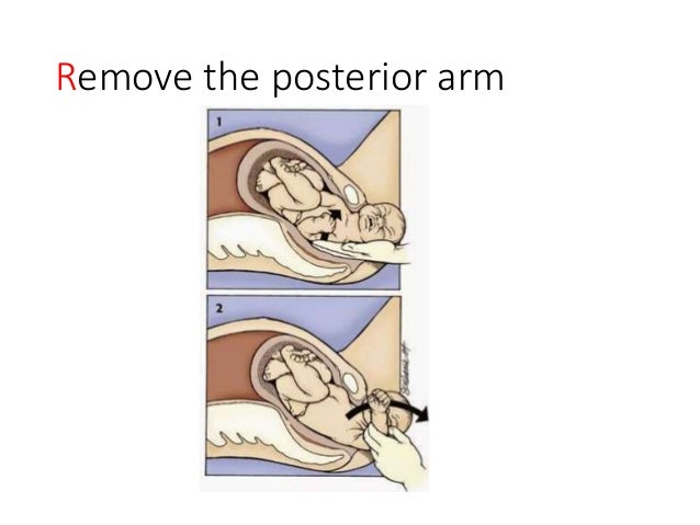 Shoulder Dystocia