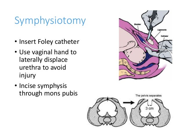Shoulder Dystocia
